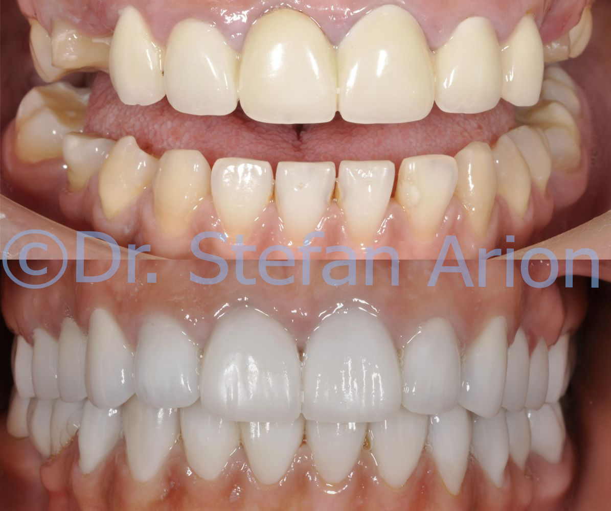 Before And After Dr Stefan Arion 2385